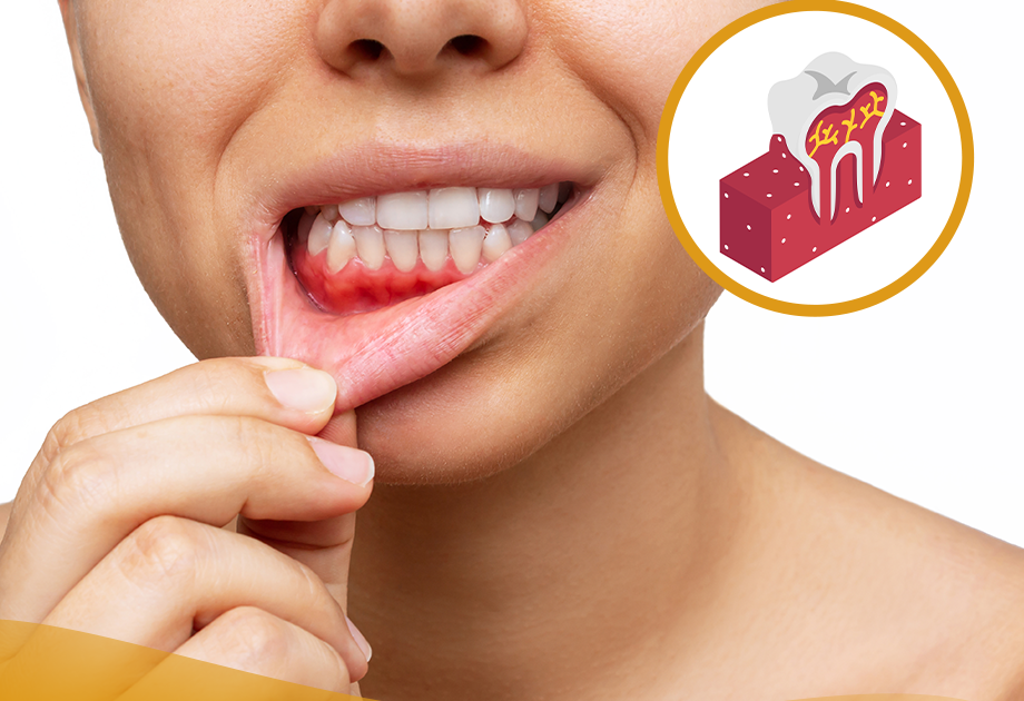 Gencives sensibles et douleurs dentaires : que faire ? - Soldent